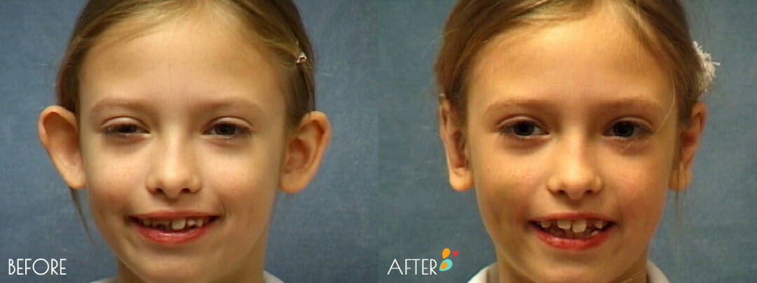 Top Ear Reshaping Dallas Surgeon | Otoplasty Plano Surgery