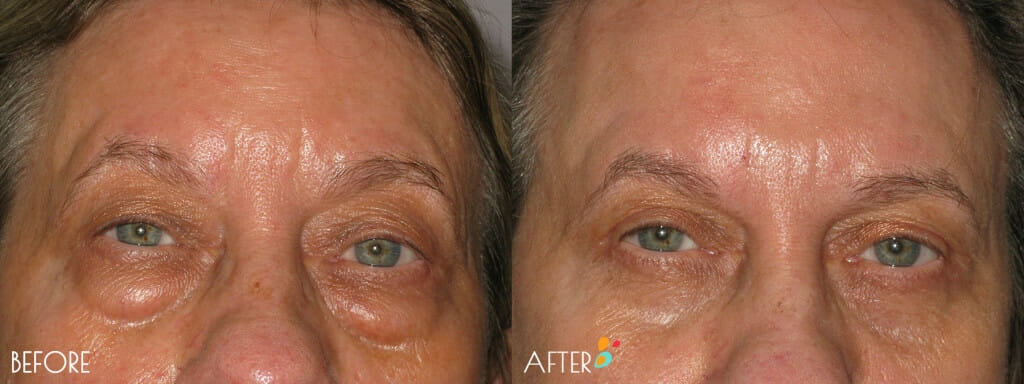 Top Eyelid Lift Dallas Surgeon | Blepharoplasty Plano Surgery