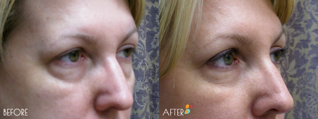 Top Eyelid Lift Dallas Surgeon | Blepharoplasty Plano Surgery