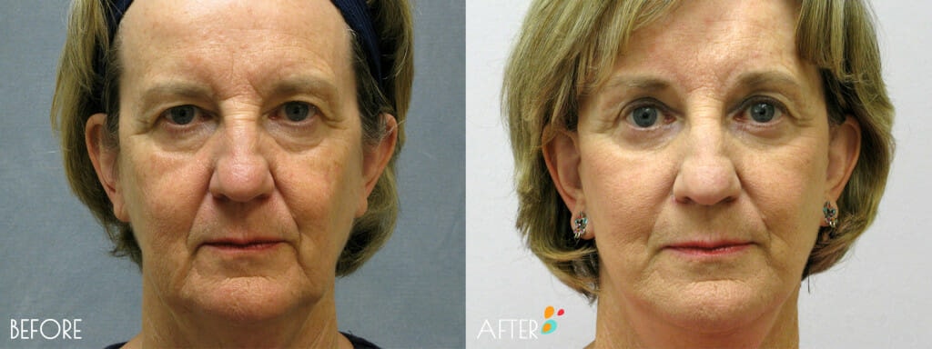 Top Face/Neck Lift Dallas & Plano Surgeon | Rhytidectomy | Cervicoplasty