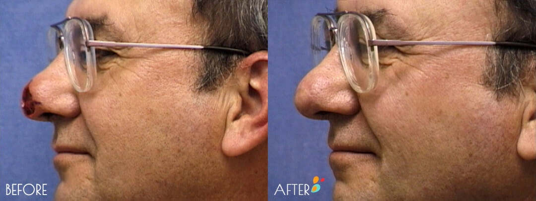 Top Skin Cancer & Mohs Closure Dallas & Plano Plastic Surgeon