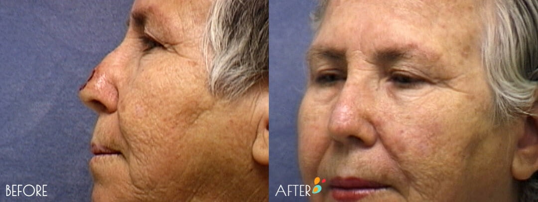 Top Skin Cancer & Mohs Closure Dallas & Plano Plastic Surgeon