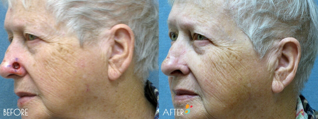Top Skin Cancer & Mohs Closure Dallas & Plano Plastic Surgeon