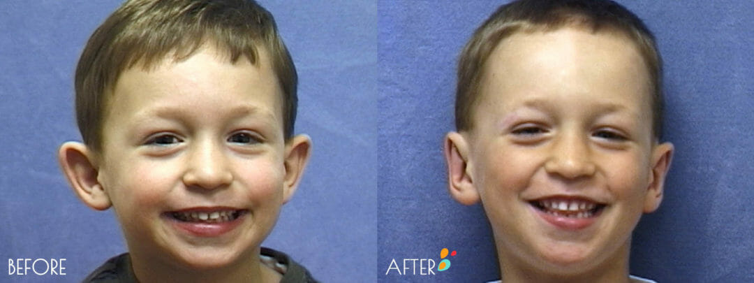 Top Ear Reshaping Dallas Surgeon | Otoplasty Plano Surgery