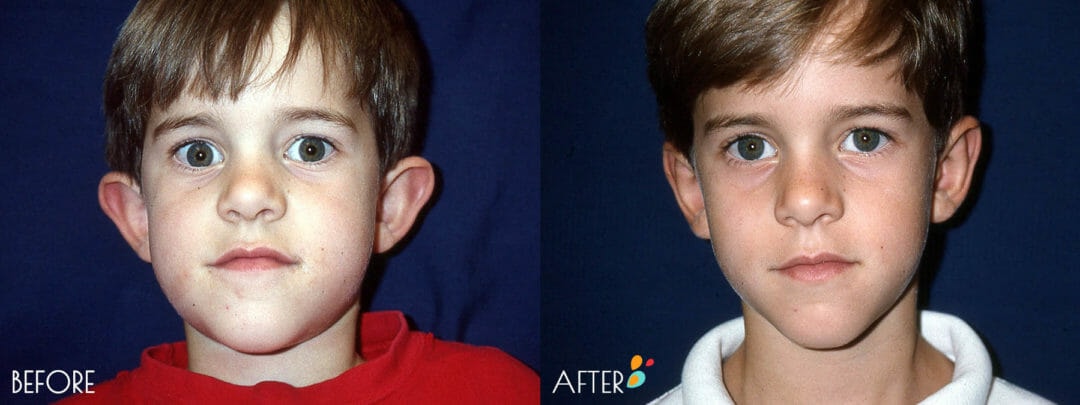 Top Ear Reshaping Dallas Surgeon | Otoplasty Plano Surgery